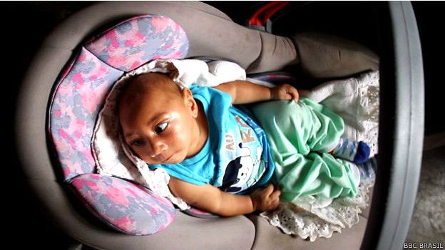 La historia del bebé con microcefalia conocido mundialmente por sus ...