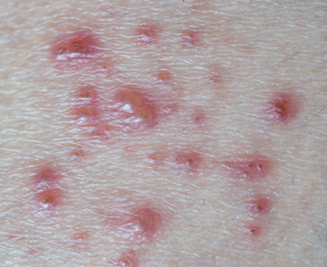 Herpes Genitalis