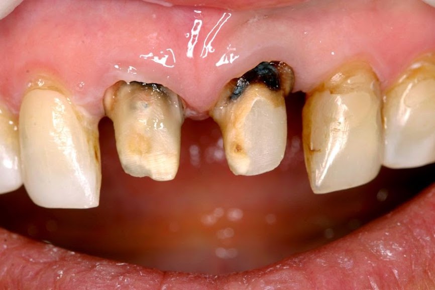 ¿Cuáles son los principales síntomas de caries en los dientes? | La Opinión