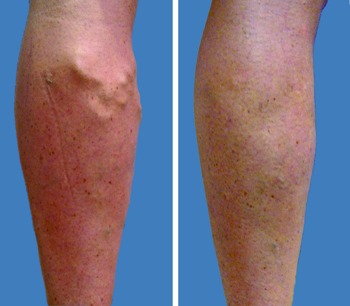 Venas varicosas: una enfermedad común pero fácil de solucionar | La Opinión