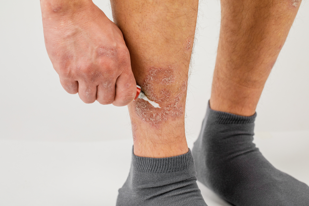 todos los días tinción mental hongos en la ingle pomada Prohibición ...