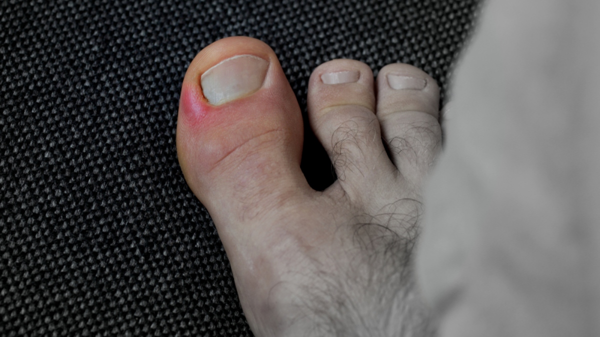 Qué puedes hacer en casa cuando se te encarna una uña - La Opinión
